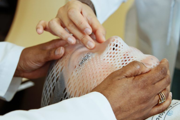 Radiation Burns: How to Cope With Radiation Burns - The Patient Story